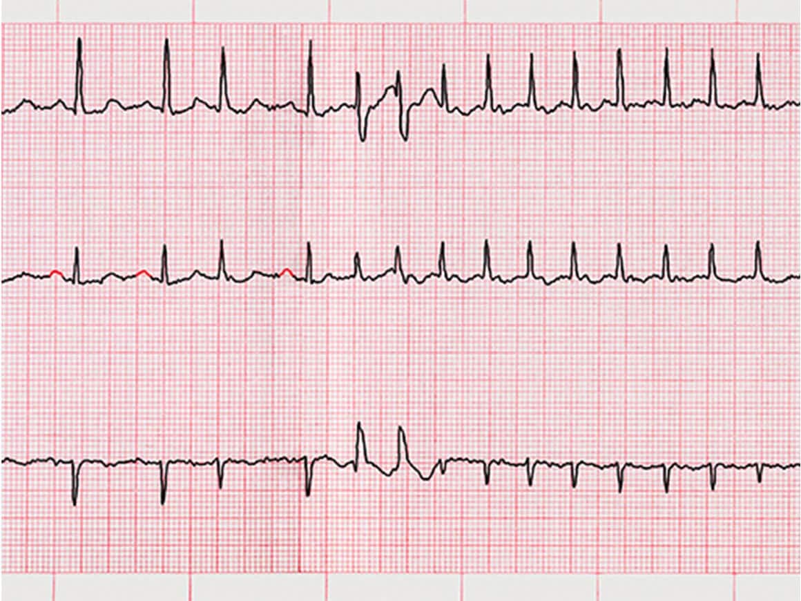 NHG-Standaard Atriumfibrilleren volledig herzien - NHG